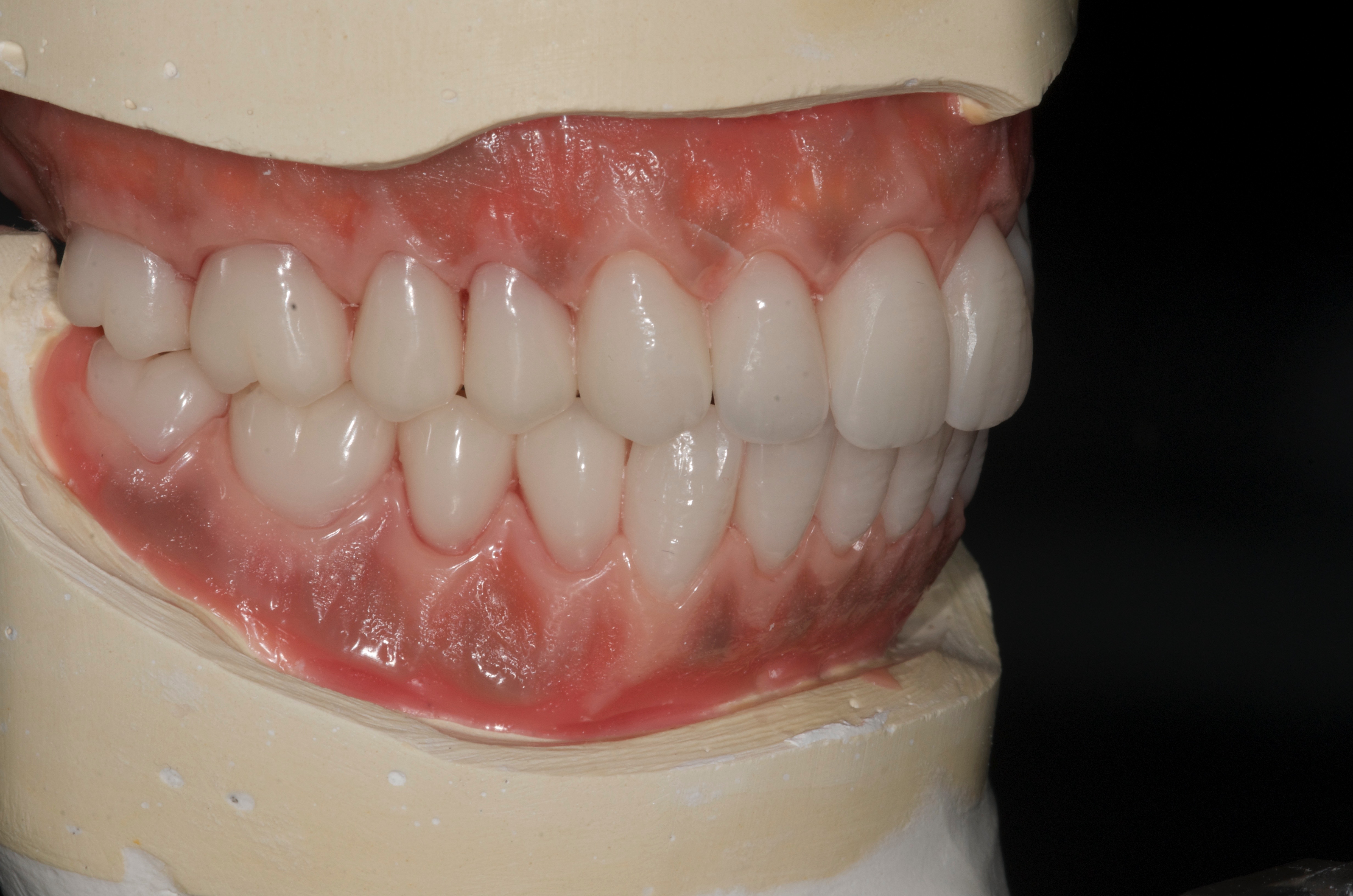 Implant Retained Overdenture - Gordana Dental Art Studio