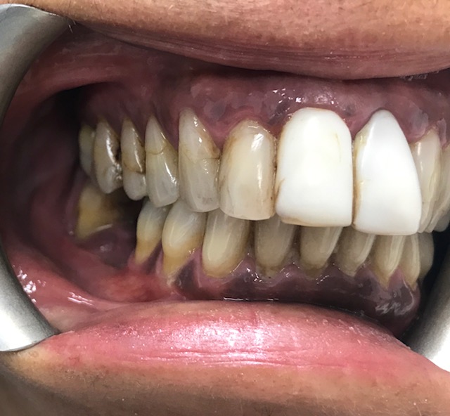 Implant Retained Overdenture - Gordana Dental Art Studio